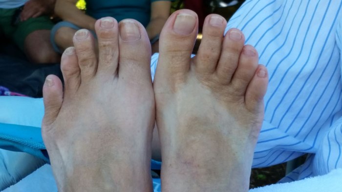 Diabetic Foot Care – Adventist Vegetarian Diabetics